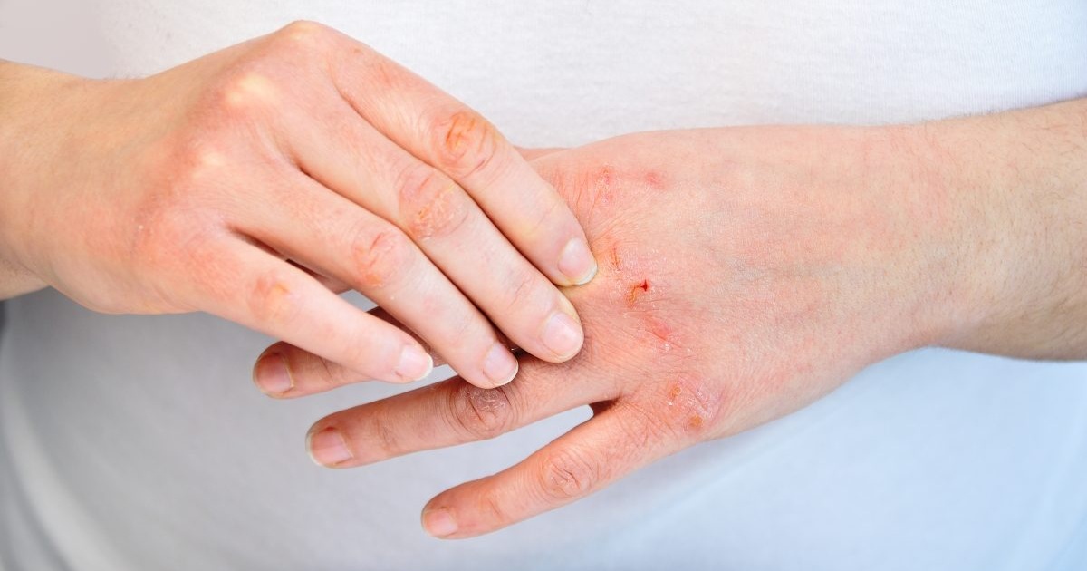 Narodni melem za ekceme - Krema za ekcem - Narodni melem